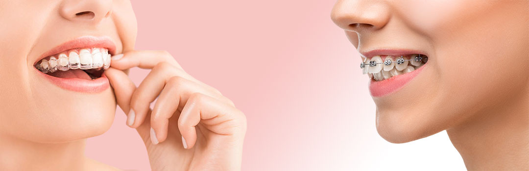 Braces & Aligners – MMR Dental